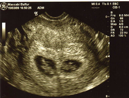 8 semanas de embarazo - Imagui