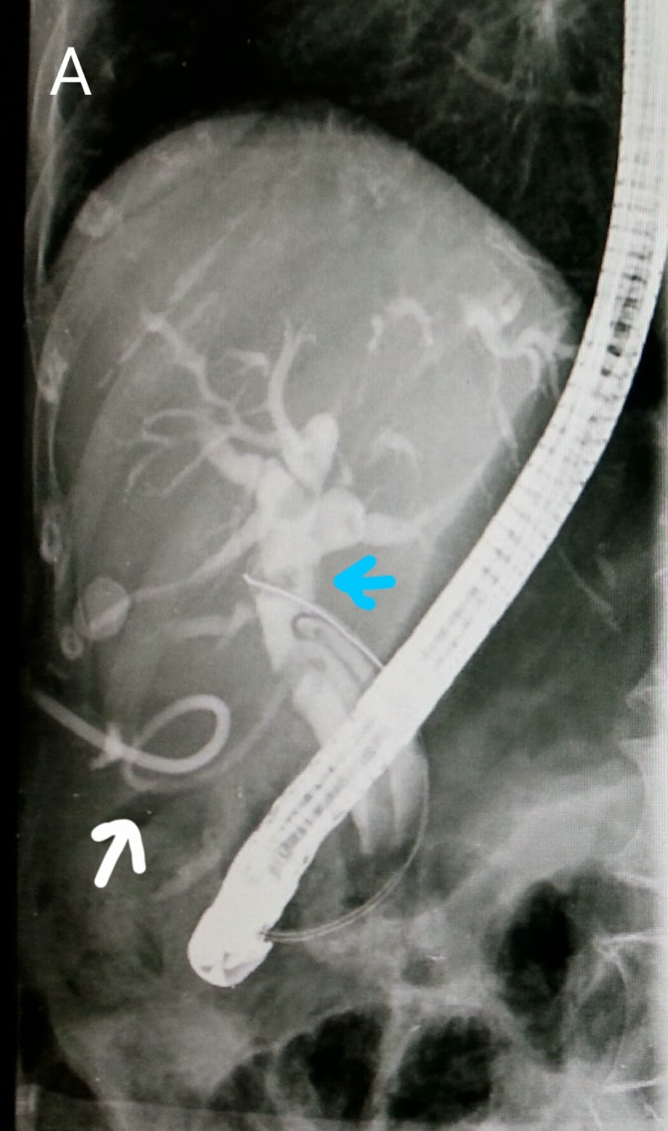 ERCP & EGD : Retained CBD stones post cholecystectomy