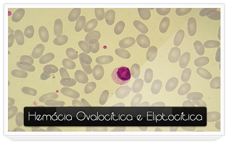 Alteração morfológica das hemácias | Biomedicina Padrão