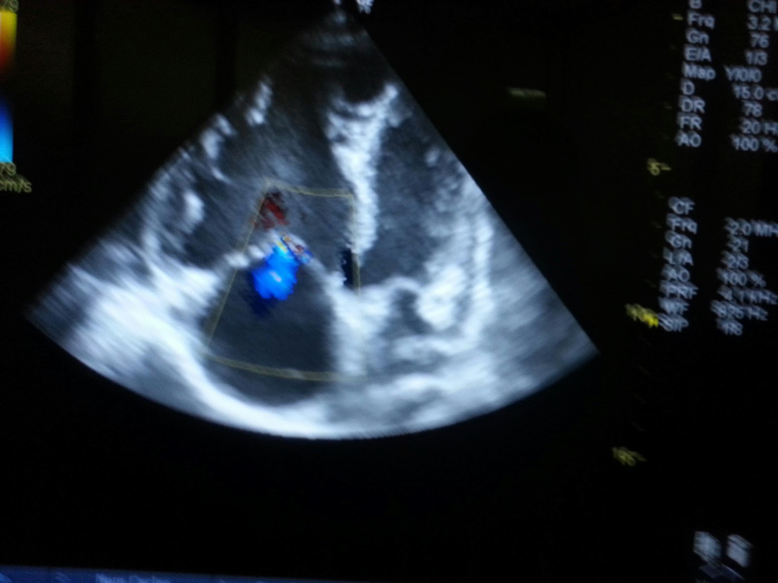 NEELZ ON WHEELZ: COR PULMONALE .dilated RA RV, pulmonary regurgitation ...