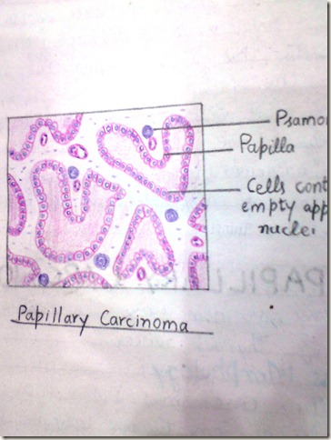 Histology Slides Database: Papillary carcinoma thyroid histopathology ...