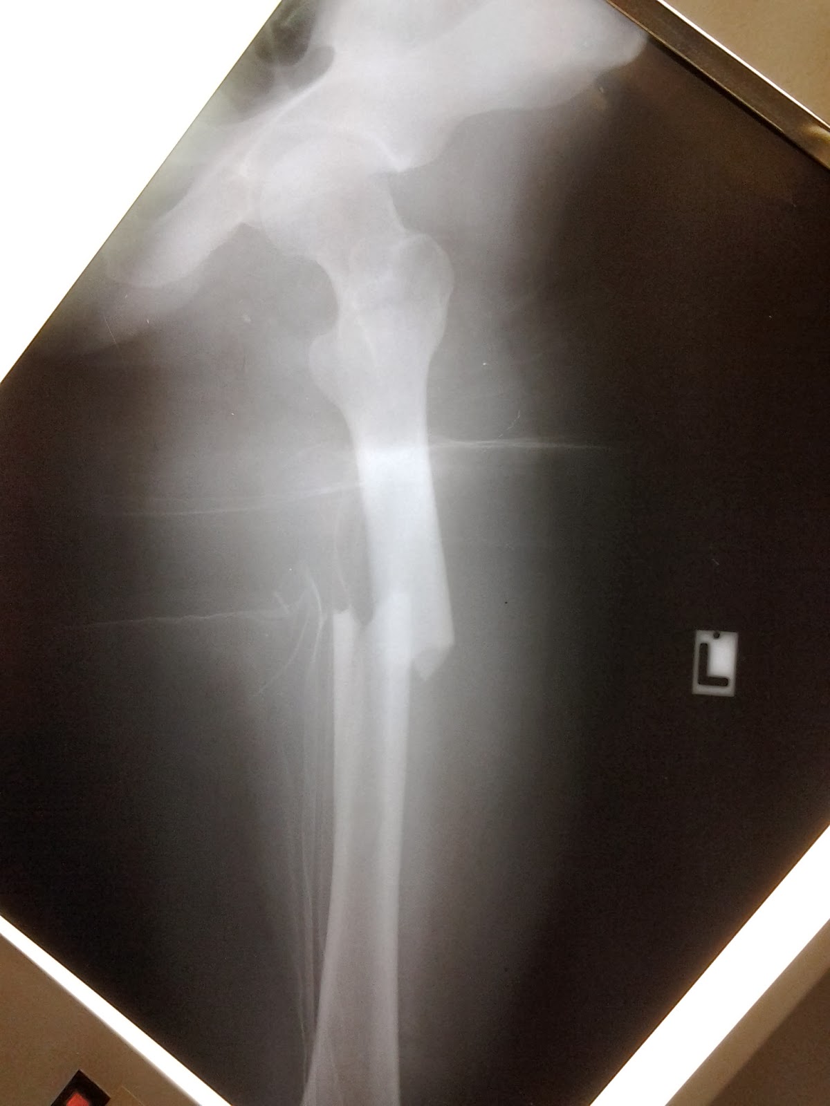 Dr Syukran: Closed proximal 3rd left femur fracture