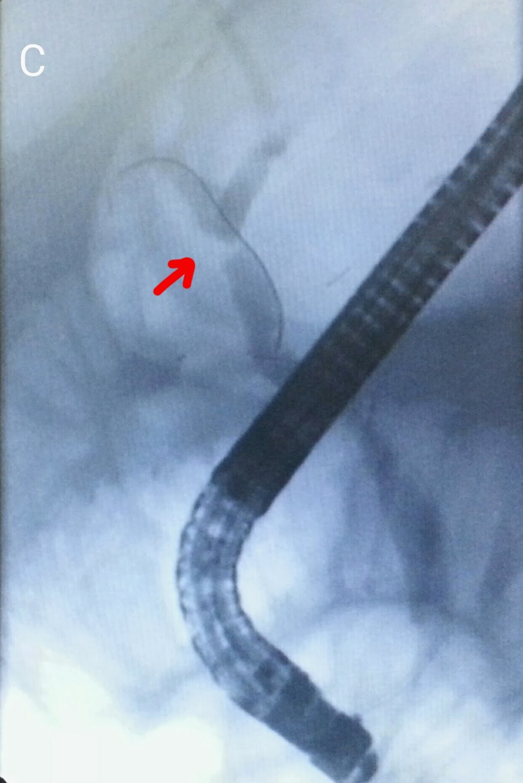 ERCP & EGD : Second follow up ERCP for post transplant anastomotic ...
