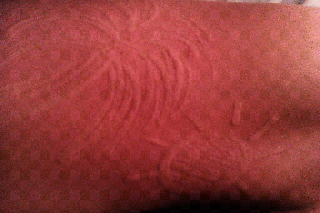 dermographic urticaria