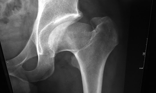 Daily Dose: Bilatetal congenital coxa vera