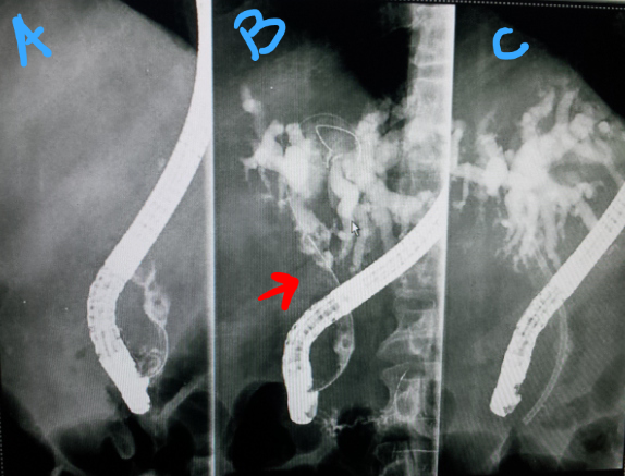 ERCP & EGD : Biliary stricture secondary to infiltration by gallbladder ...
