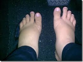 Gejala Kaki Bengkak dan Jenisnya | Kerozzi