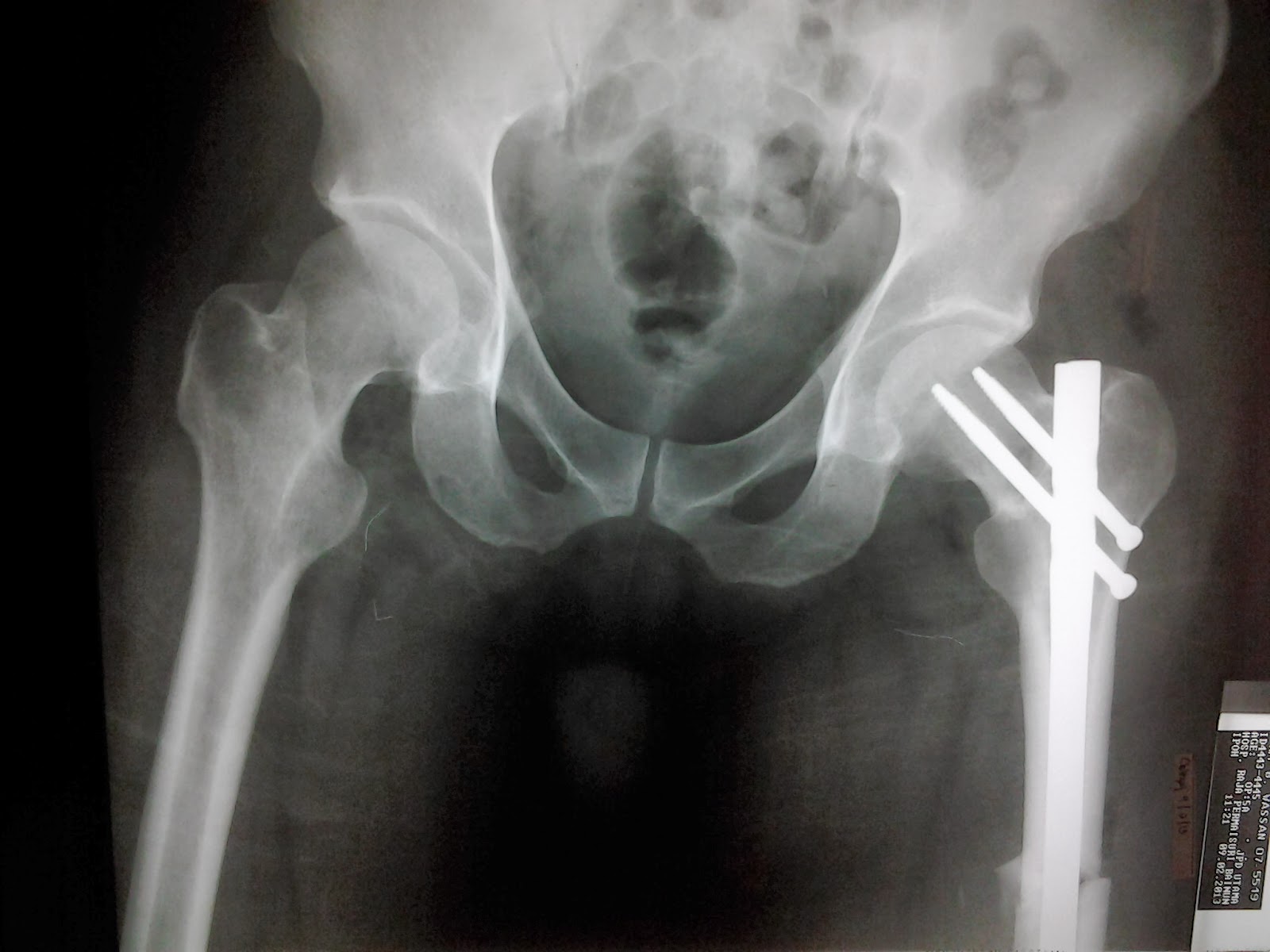 Dr Syukran: Closed proximal 3rd left femur fracture
