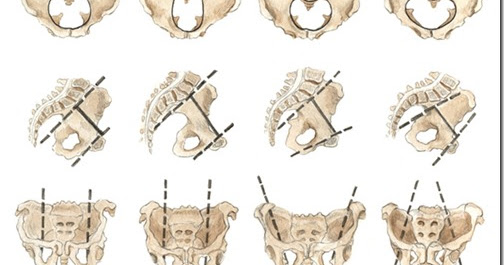Types of Female Pelvis, Shapes of Female Pelvis and Child Birth ...