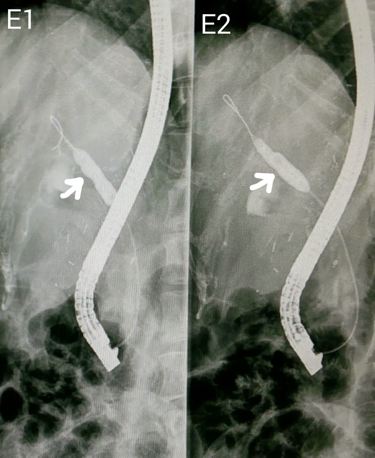 ERCP & EGD : Third follow-up ERCP for post transplant anastomotic ...
