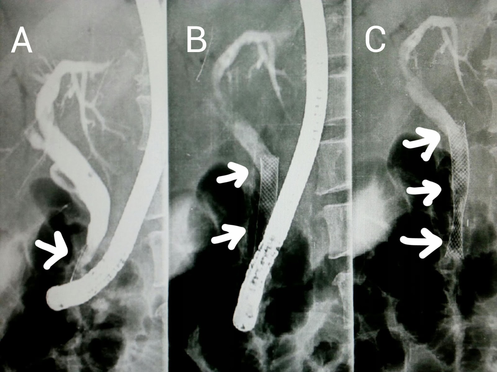 ERCP & EGD : And another unresectable ampullary tumor