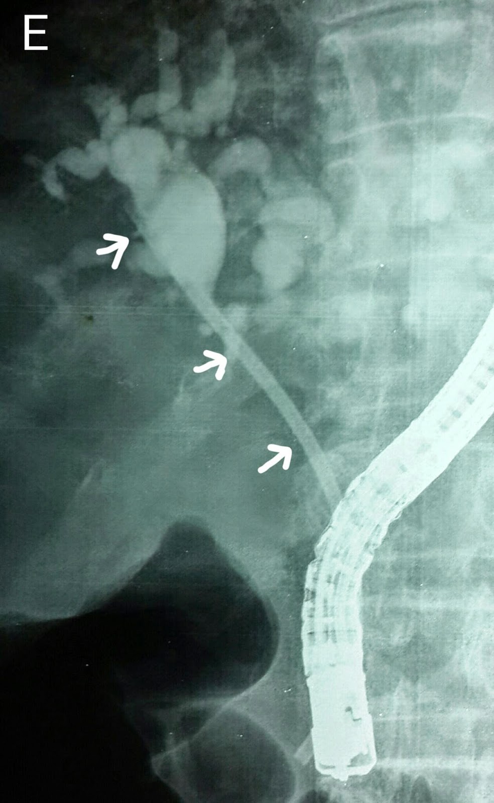 ERCP & EGD : Managing a hilar stricture (or trying to, at least)