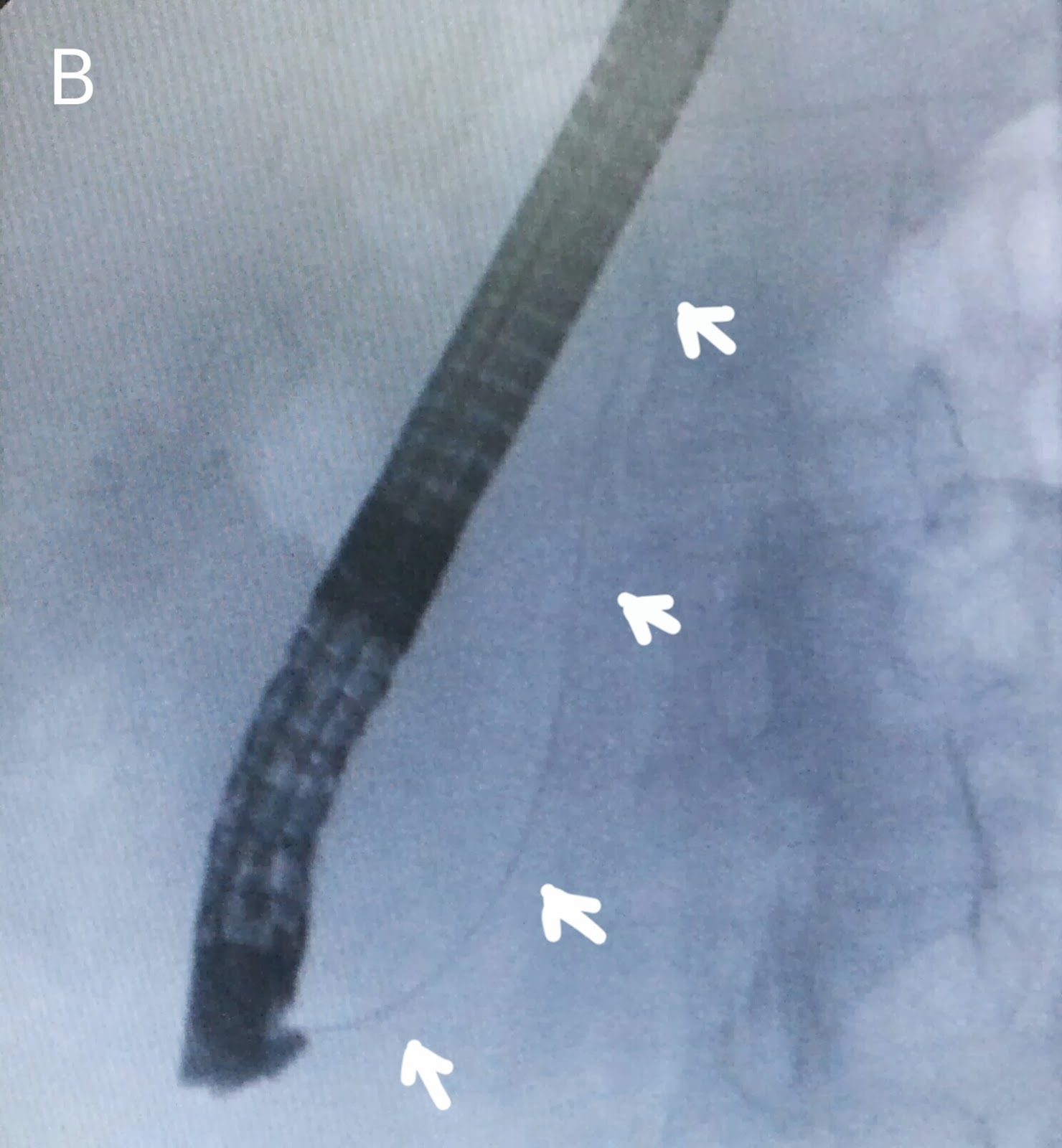 ERCP & EGD : Post transplant anastomotic biliary stricture occurring 7 ...