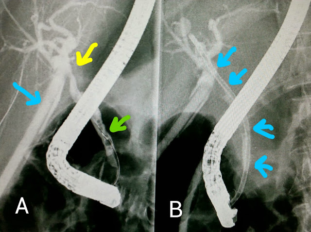 ERCP & EGD : Stenting a biliary leak