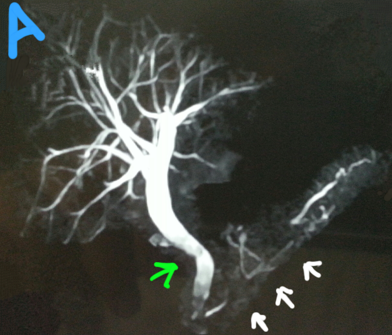ERCP & EGD : Managing choledocholithiasis and a damaged pancreatic duct ...