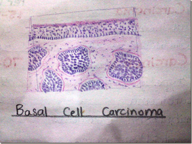 Histology Slides Database: Basal Cell Carcinoma Histopathology Diagrams