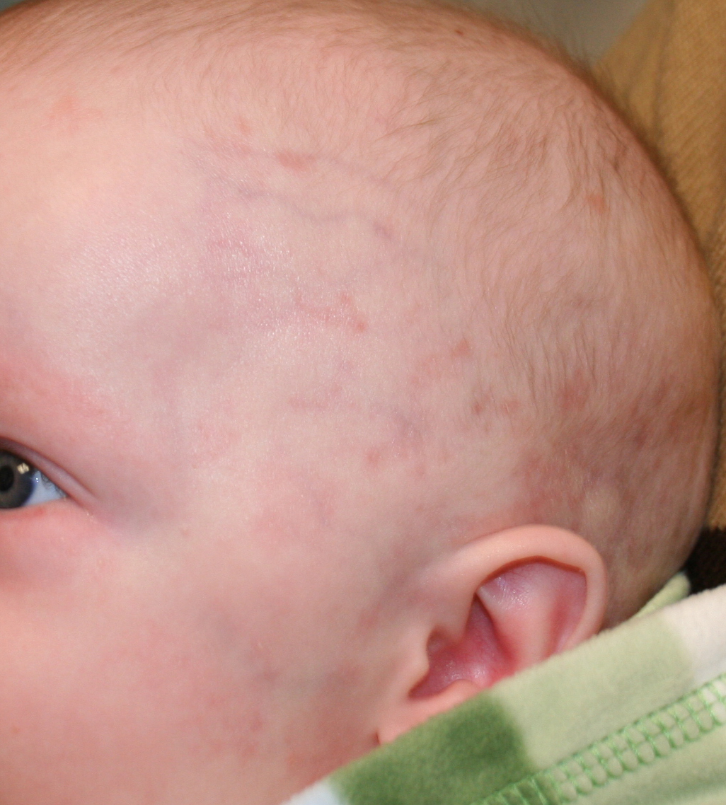 Lupus eritematoso.: Lupus neonatal