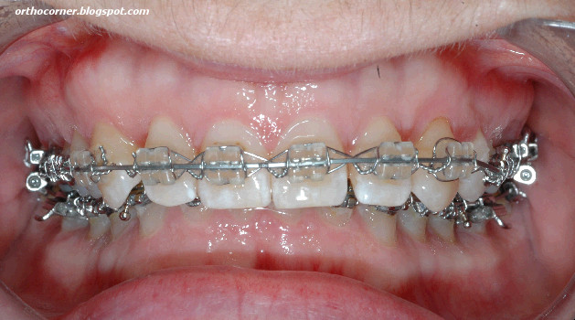 Orthodontic Corner: Class II div 2 Deep Bite, Where is the Limit
