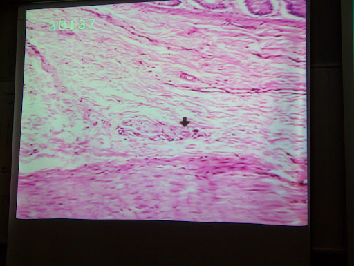 Ganglion cystbehind lungs 'intra facet dorsal root ganglion block ...