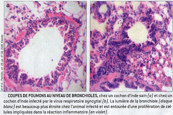 Dr Gamin Pédiatre : tout sur l'enfant: La bronchiolite du nourrisson ...