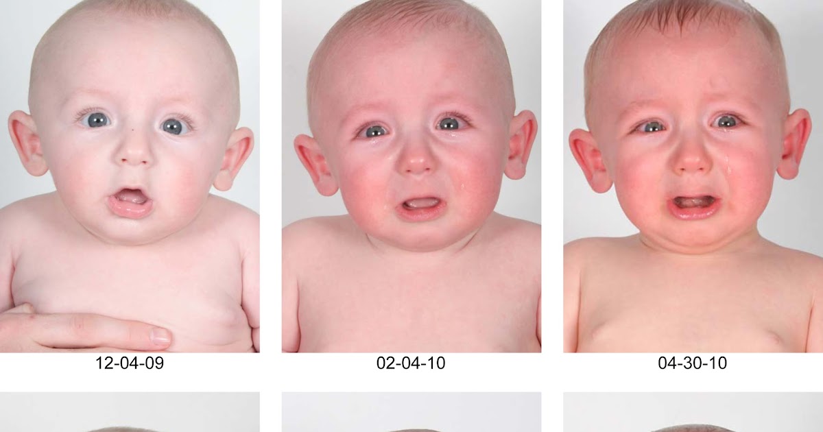 Mom of One—and Done!: Brachycephaly