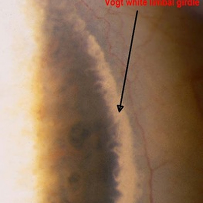 Limbal Girdle Of Vogt