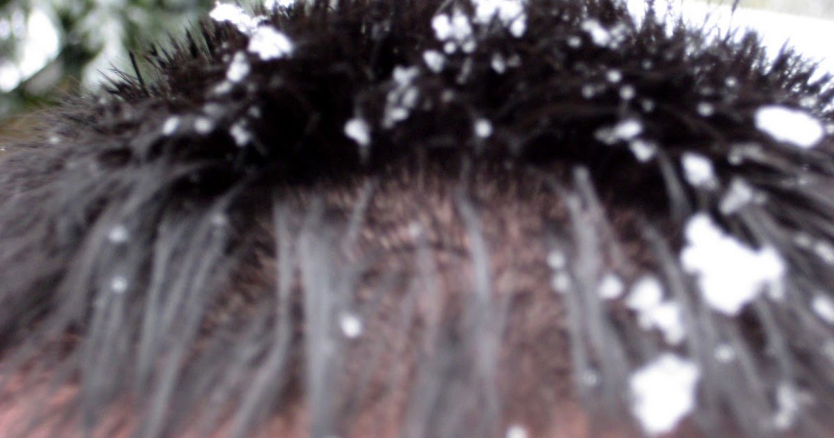 Worst Dandruff Case